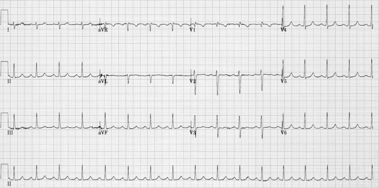 Supraventricular Tachycardia (SVT) • LITFL • ECG Library Diagnosis
