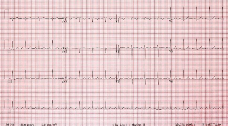 ECG Case 017 • LITFL • ECG Top 100 Self-Assessment Quiz