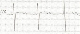U Wave • LITFL Medical Blog • ECG Library Basics