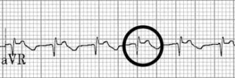 Supraventricular Tachycardia (SVT) • LITFL • ECG Library Diagnosis