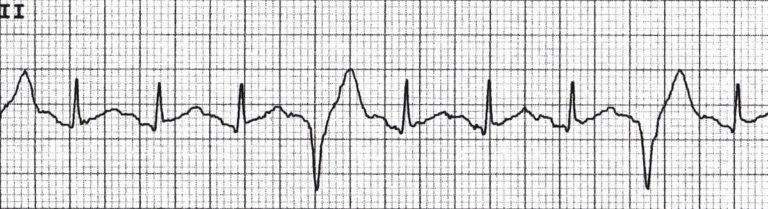 Premature Ventricular Complex (PVC) • LITFL • ECG Library Diagnosis