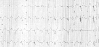 Pacemaker Rhythms – Normal Patterns • LITFL • ECG Library Diagnosis