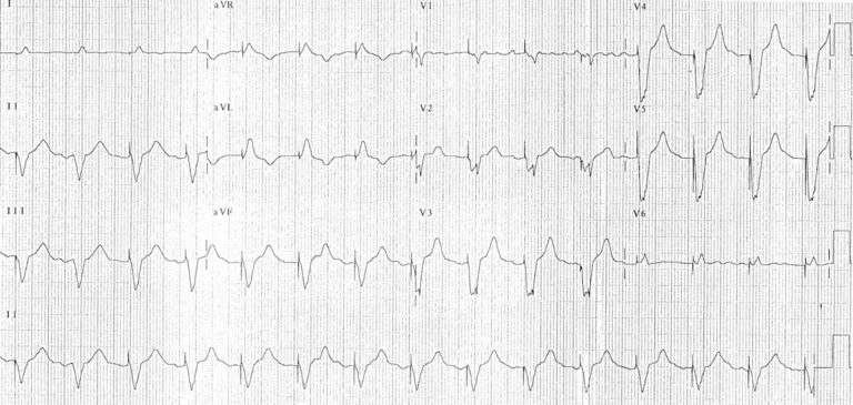 Pacemaker Rhythms – Normal Patterns • LITFL • ECG Library Diagnosis