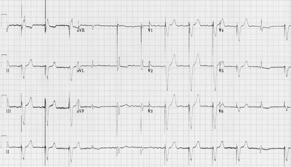 Pacemaker Rhythms – Normal Patterns • LITFL • ECG Library Diagnosis