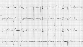 Pacemaker Rhythms – Normal Patterns • LITFL • ECG Library Diagnosis