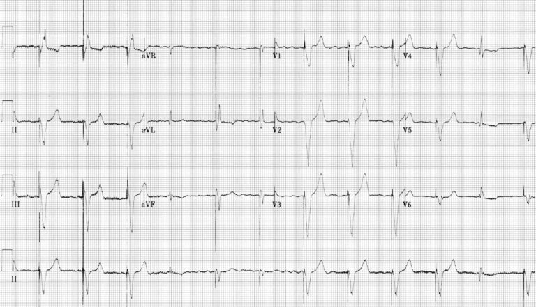 Pacemaker Rhythms – Normal Patterns • LITFL • ECG Library Diagnosis