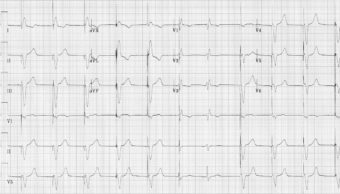 Pacemaker Rhythms – Normal Patterns • LITFL • ECG Library Diagnosis