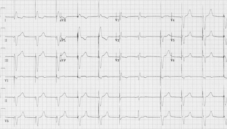 Pacemaker Rhythms – Normal Patterns • LITFL • ECG Library Diagnosis