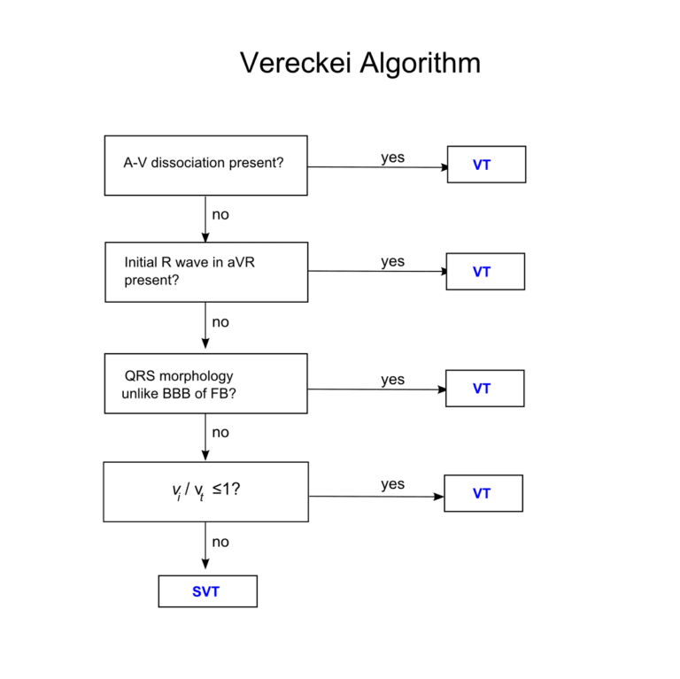VT versus SVT • LITFL Medical Blog • ECG Library Basics