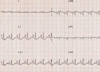 ECG Axis Interpretation • LITFL • ECG Library Basics