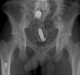 Top 10 X-Ray Foreign Bodies • LITFL • Arcanum veritas