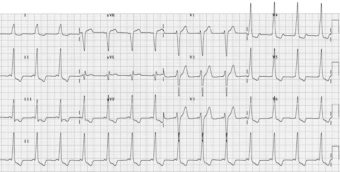 Pre-excitation syndromes • LITFL • ECG Library Diagnosis