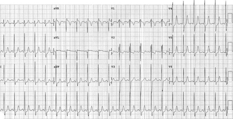 Atrioventricular Re-entry Tachycardia (AVRT) • LITFL • ECG Library ...