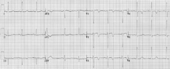 Wellens Syndrome • LITFL • ECG Library Eponym