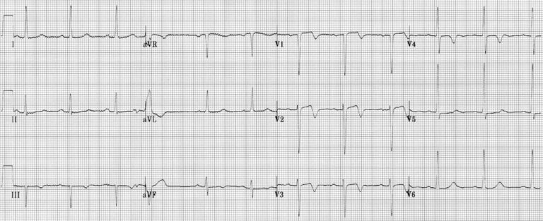 Wellens Syndrome • LITFL • ECG Library Eponym