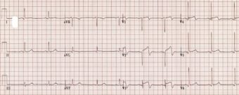 Wellens Syndrome • LITFL • ECG Library Eponym
