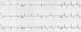 Wellens Syndrome • LITFL • ECG Library Eponym