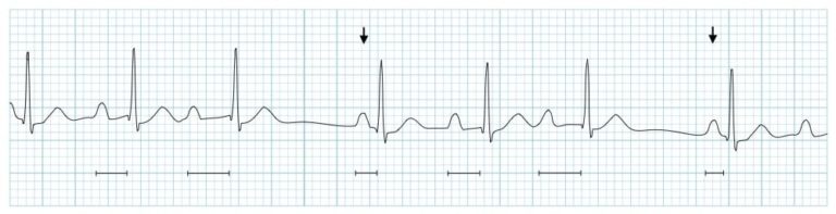 Diagnosis, Wenckebach Squared? • LITFL • ECG Exigency