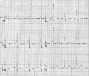 R wave • LITFL • ECG Library Basics