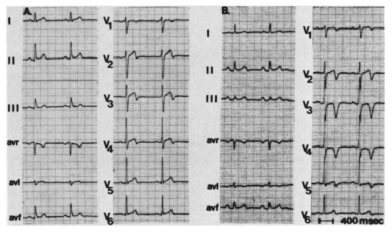 Wellens Syndrome • LITFL • ECG Library Eponym