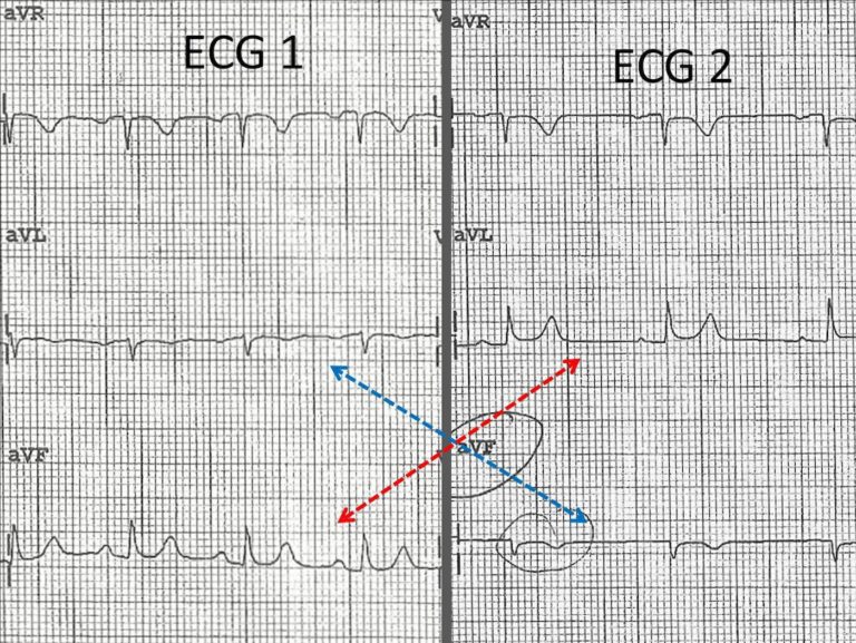 ECG Case 078 • LITFL • ECG Top 100 Self-Assessment Quiz