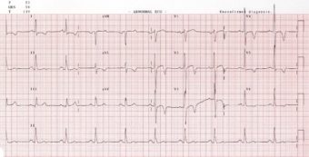 Hypertrophic Cardiomyopathy (HCM) • LITFL • ECG Library Diagnosis