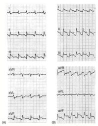 PR segment • LITFL • ECG Library Basics