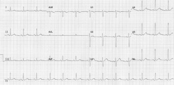 Benign Early Repolarisation • LITFL • ECG Library Diagnosis