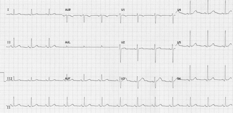 Benign Early Repolarisation • LITFL • ECG Library Diagnosis