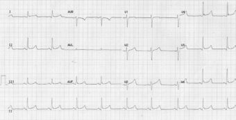 Benign Early Repolarisation • LITFL • ECG Library Diagnosis