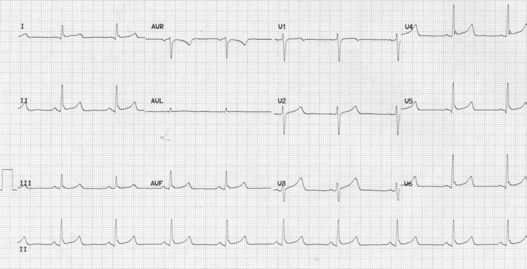 Benign Early Repolarisation • LITFL • ECG Library Diagnosis