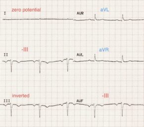 ECG Limb Lead Reversal • LITFL • ECG Library Diagnosis