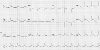 Raised Intracranial Pressure ECG Changes • LITFL • ECG Library