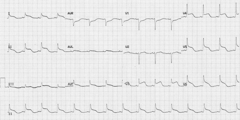 Raised Intracranial Pressure ECG Changes • LITFL • ECG Library Raised Intracranial Pressure ECG Changes • LITFL • ECG Library
