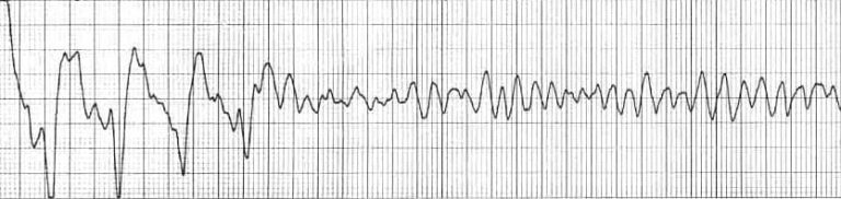 ECG Motion Artefacts • LITFL • ECG Library Diagnosis