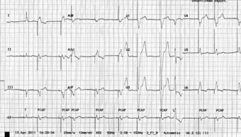 Pacemaker Rhythms – Normal Patterns • LITFL • ECG Library Diagnosis