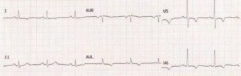 T wave • LITFL • ECG Library Basics