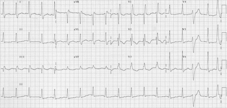 ECG changes in Pulmonary Embolism • LITFL • ECG Library