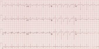 T wave • LITFL • ECG Library Basics