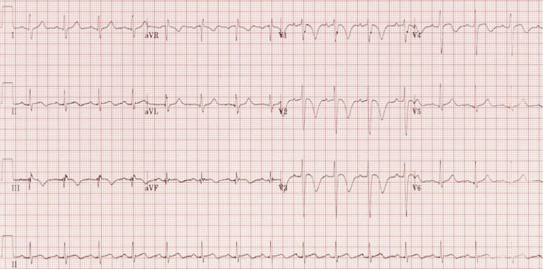 T wave • LITFL • ECG Library Basics