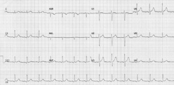 Normal Sinus Rhythm • LITFL Medical Blog • ECG Library Basics