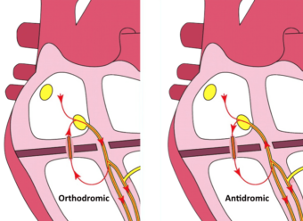 Atrioventricular Re-entry Tachycardia (AVRT) • LITFL • ECG Library ...