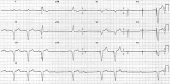 Pacemaker Malfunction • LITFL • ECG Library Diagnosis
