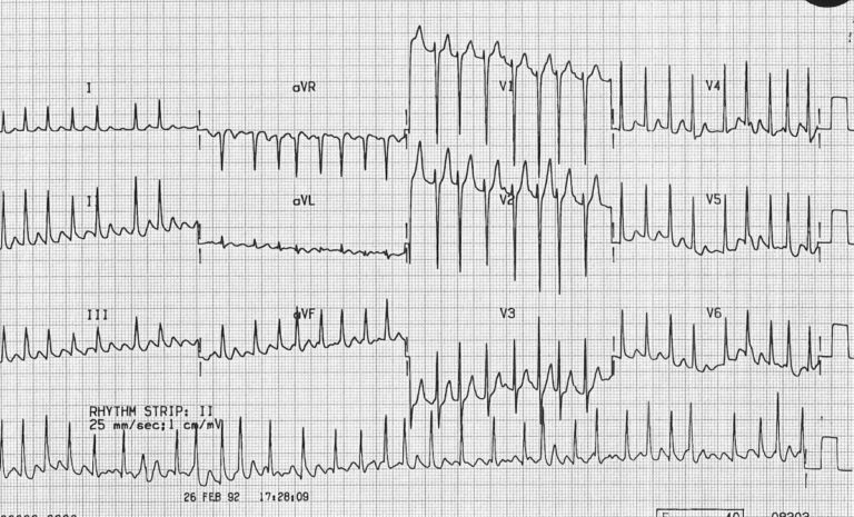 Hyperthyroidism ECG changes • LITFL • ECG Library Diagnosis