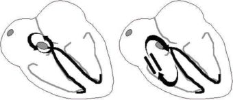 Supraventricular Tachycardia (SVT) • LITFL • ECG Library Diagnosis