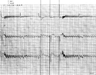 Pacemaker Malfunction • LITFL • ECG Library Diagnosis