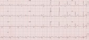 Trifascicular Block • LITFL • ECG Library Diagnosis