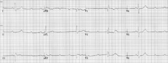 Trifascicular Block • LITFL • ECG Library Diagnosis
