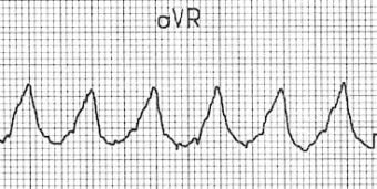 VT versus SVT • LITFL Medical Blog • ECG Library Basics