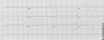 Wellens Syndrome • LITFL • ECG Library Eponym